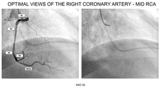 NORMAL CORONARY ANATOMY AND ANGIOGRAPHIC VIEWS SOURCE.pptx