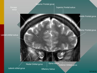 Normal Cortical Anatomy.pptx