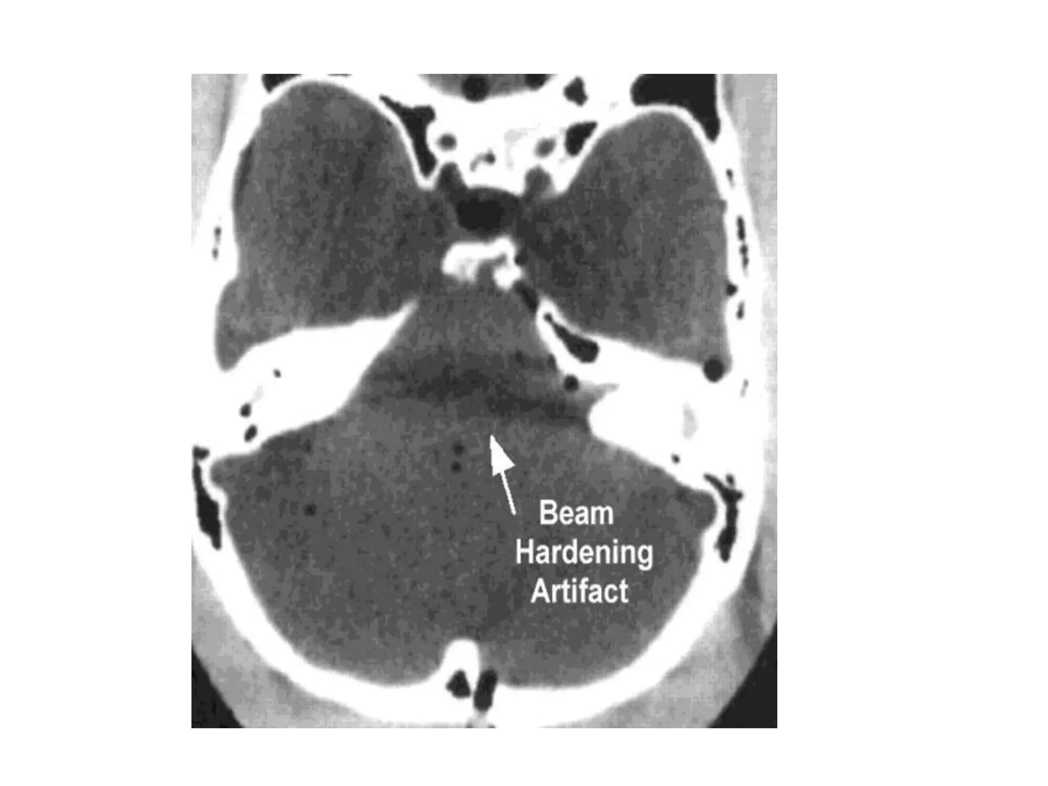 Normal CT BRAIN | PPTX