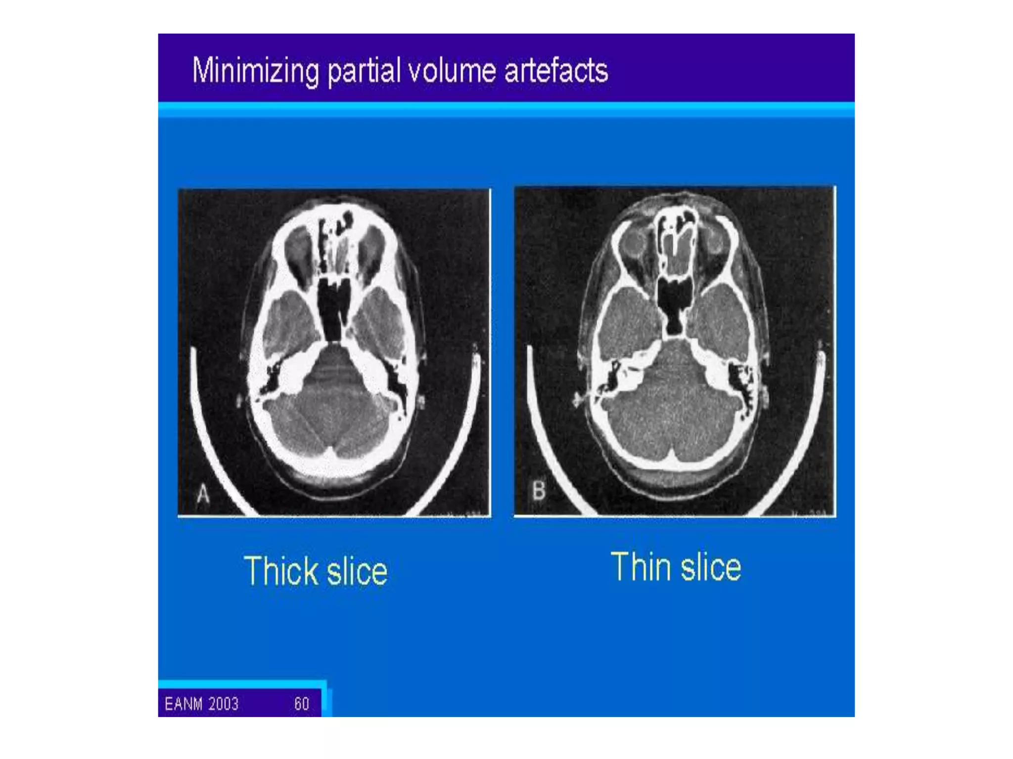 Normal CT BRAIN | PPTX