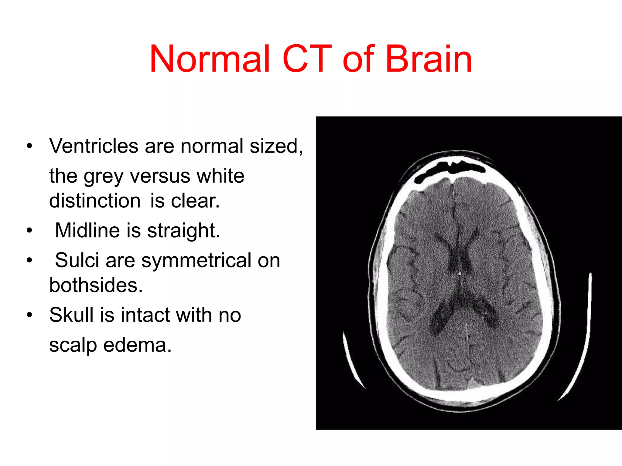 Normal CT BRAIN | PPTX