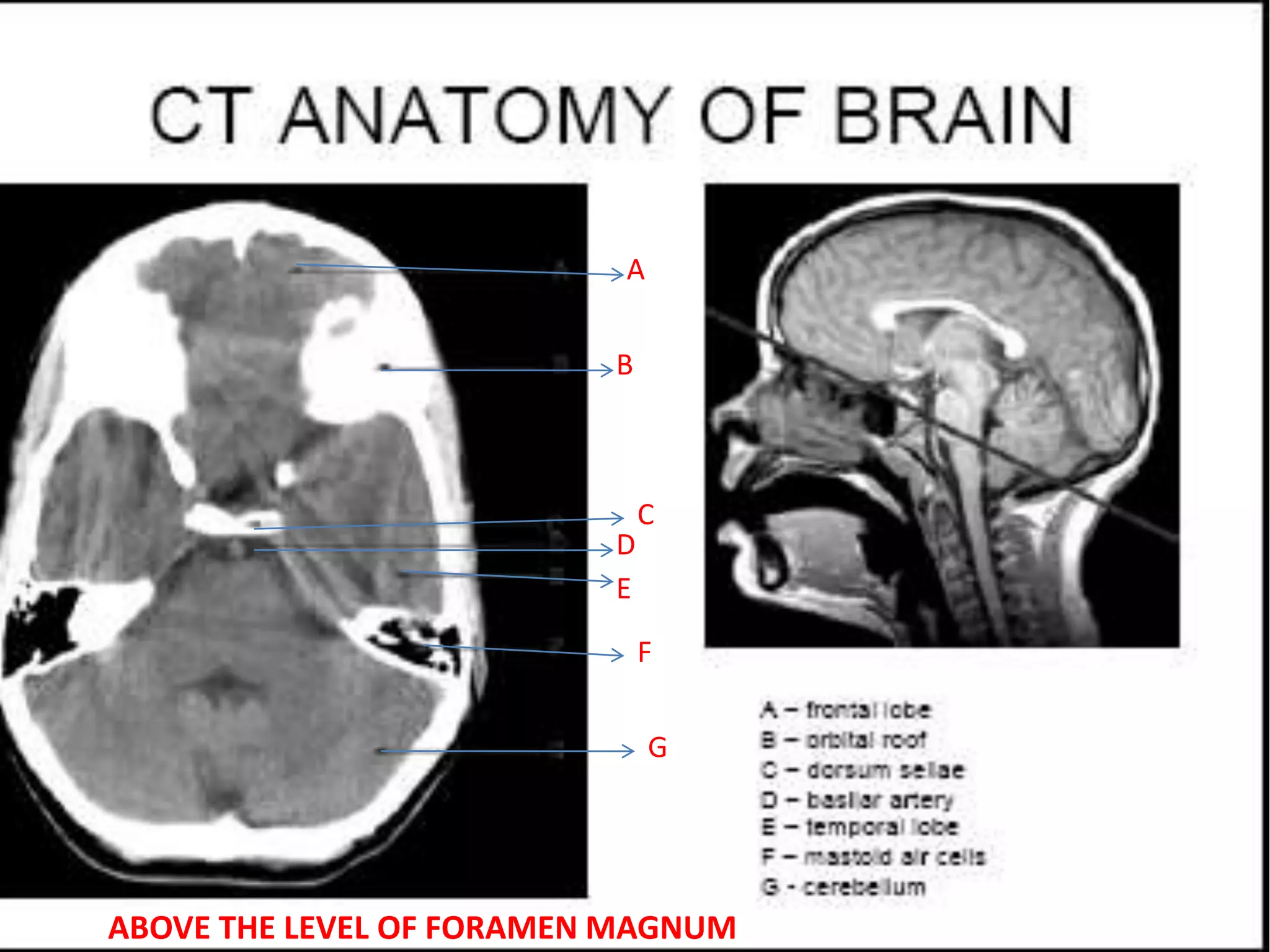 Normal CT BRAIN | PPTX