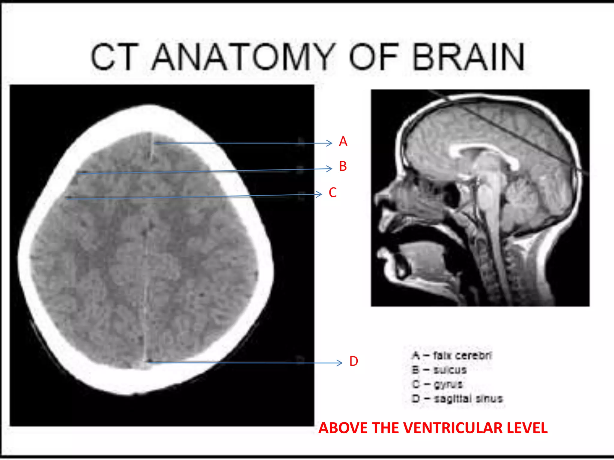 Normal CT BRAIN | PPTX