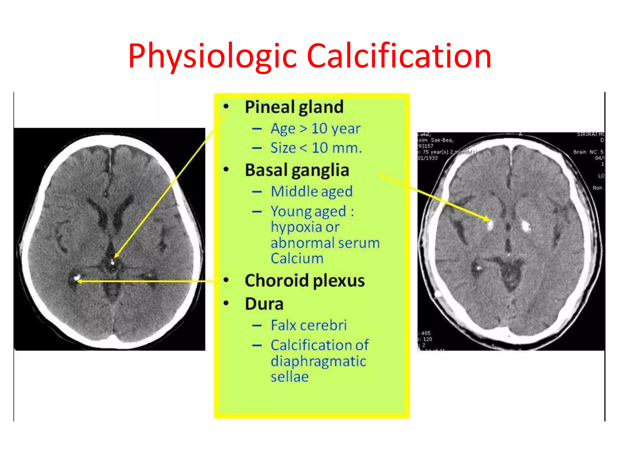 Normal CT BRAIN | PPTX