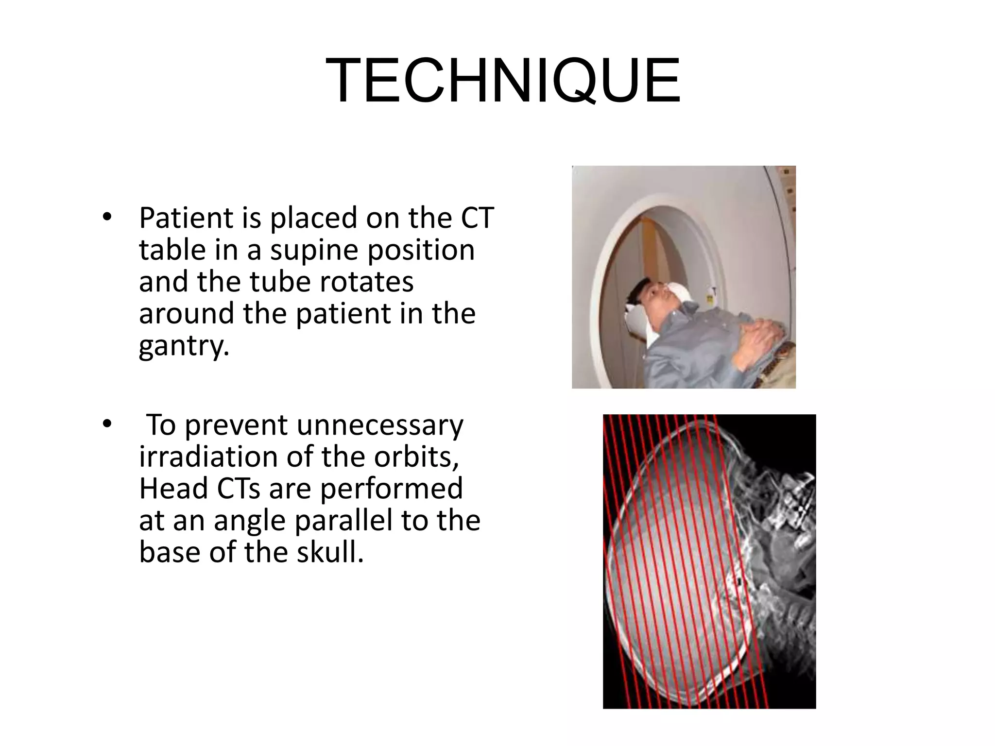 Normal CT BRAIN | PPTX