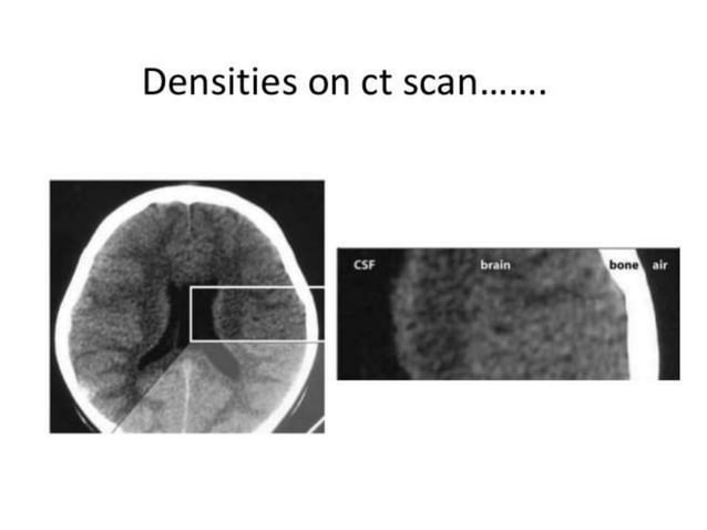 Normal CT BRAIN | PPTX | Brain and Nervous System Disorders | Diseases ...
