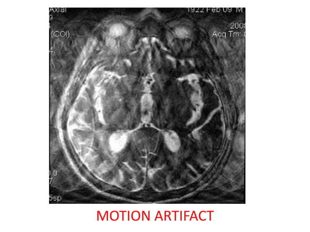 Normal CT BRAIN | PPTX | Brain and Nervous System Disorders | Diseases ...