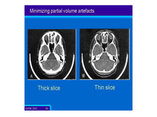 Normal CT BRAIN | PPTX
