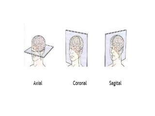 Normal CT BRAIN | PPTX