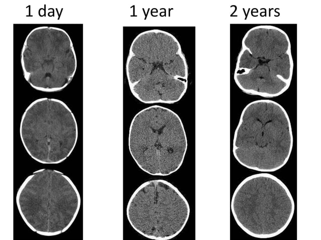 Normal CT BRAIN | PPTX | Brain and Nervous System Disorders | Diseases ...