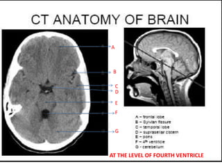 Normal CT BRAIN | PPTX