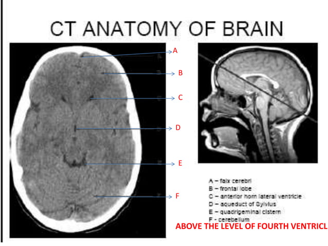 Normal CT BRAIN | PPTX | Brain and Nervous System Disorders | Diseases ...