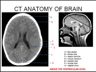 Normal CT BRAIN | PPTX
