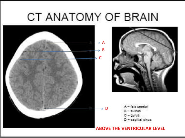 Normal CT BRAIN | PPTX | Brain and Nervous System Disorders | Diseases ...
