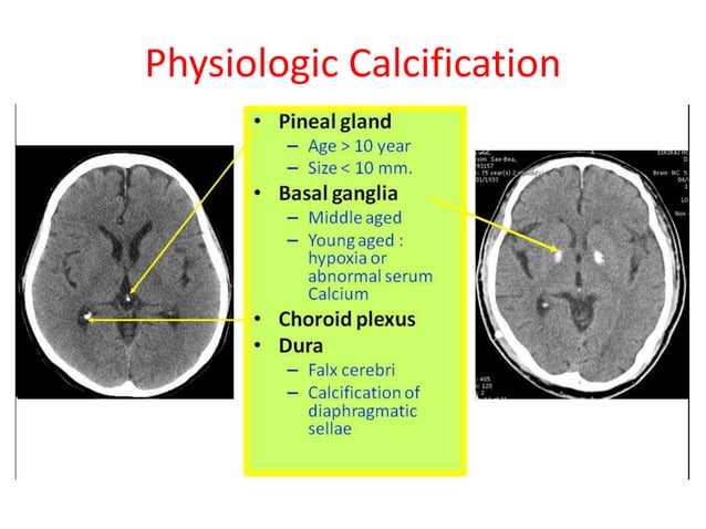 Normal CT BRAIN | PPTX | Brain and Nervous System Disorders | Diseases ...