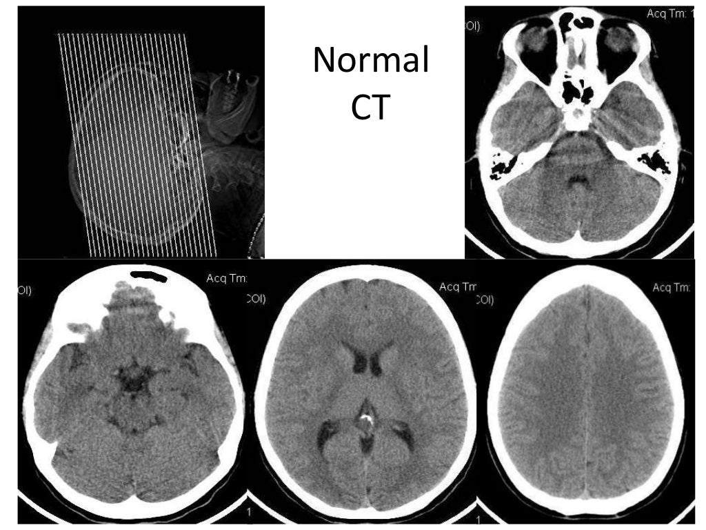 Normal Ct Brain