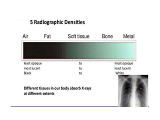 Normal cxr agp | PPT