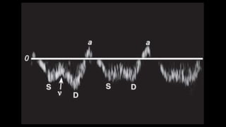 Normal doppler spectral pattern of abdominal and limb vessels final | PPTX