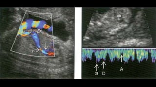 Normal doppler spectral pattern of abdominal and limb vessels final | PPTX