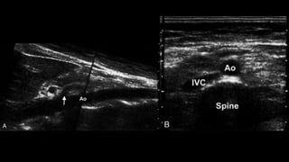 Normal doppler spectral pattern of abdominal and limb vessels final | PPTX