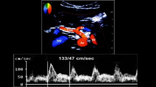 Normal doppler spectral pattern of abdominal and limb vessels final | PPTX