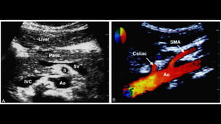 Normal doppler spectral pattern of abdominal and limb vessels final | PPTX