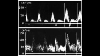 Normal doppler spectral pattern of abdominal and limb vessels final | PPTX