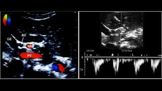 Normal doppler spectral pattern of abdominal and limb vessels final | PPTX
