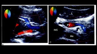 Normal doppler spectral pattern of abdominal and limb vessels final | PPTX