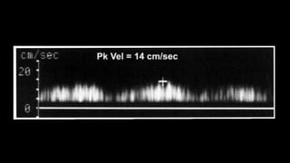 Normal doppler spectral pattern of abdominal and limb vessels final | PPTX