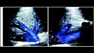 Normal doppler spectral pattern of abdominal and limb vessels final | PPTX