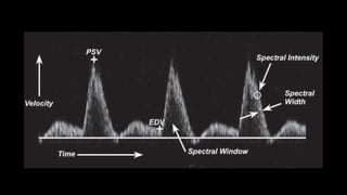 Normal doppler spectral pattern of abdominal and limb vessels final | PPTX