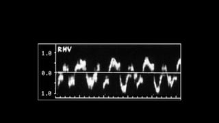 Normal doppler spectral pattern of abdominal and limb vessels final | PPTX