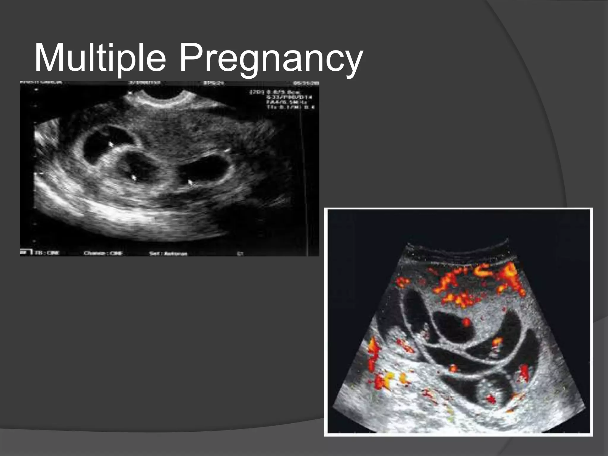 Normal early pregnancy imaging | PPT