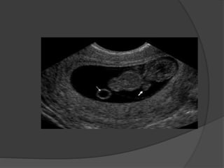 Normal early pregnancy imaging | PPTX