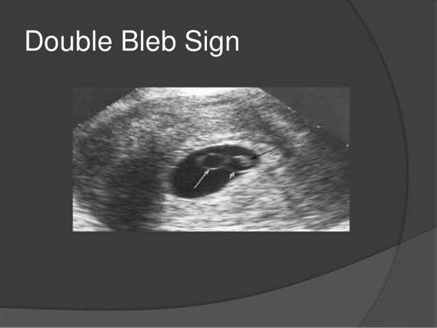 Normal early pregnancy imaging