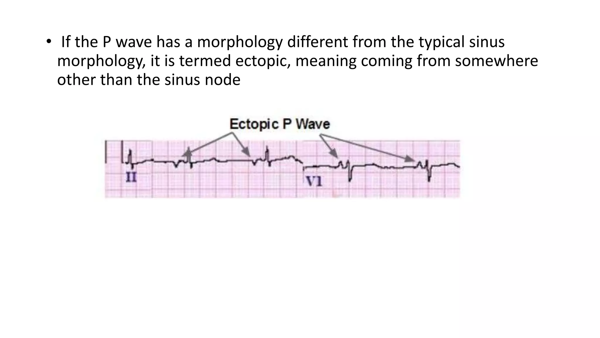 NORMAL ECG.pptx