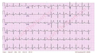 NORMAL ECG.pptx