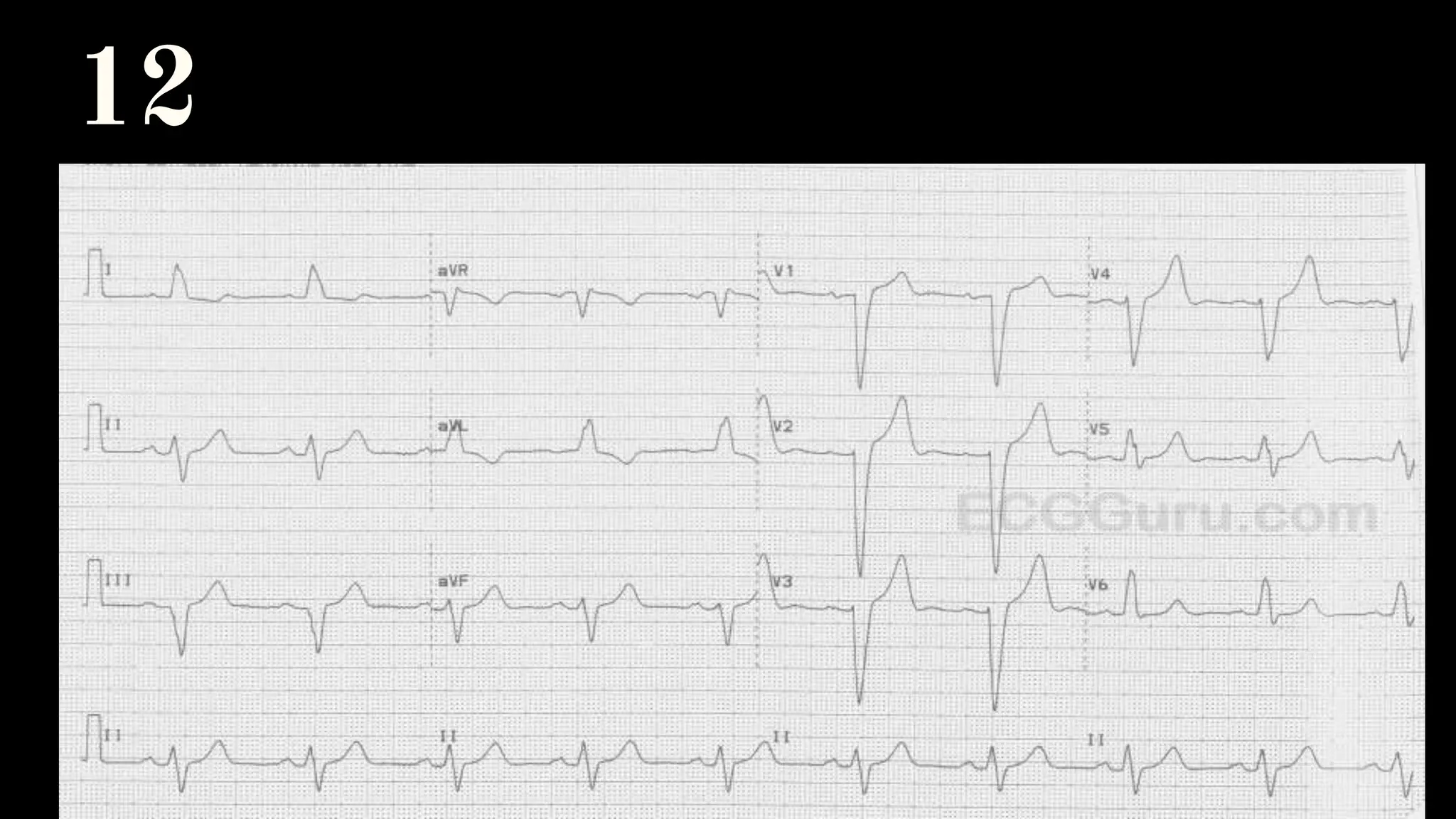 NORMAL Electrocardiography for Medical and Nursing Students | PPTX
