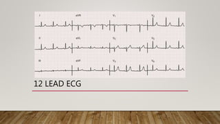 12 LEAD NORMAL ELECTROCARDIOGRAM | PPTX