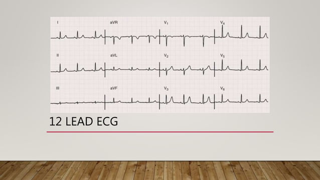 12 LEAD NORMAL ELECTROCARDIOGRAM | PPTX