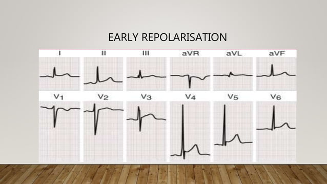 12 LEAD NORMAL ELECTROCARDIOGRAM | PPTX