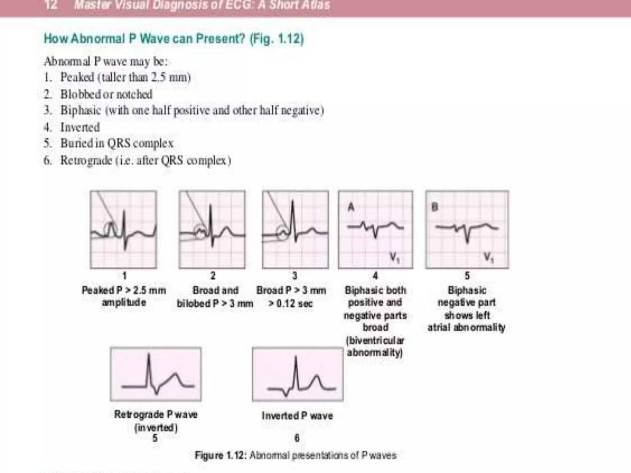 Normal ecg interpretation | PPTX | Heart and Cardiovascular Diseases ...