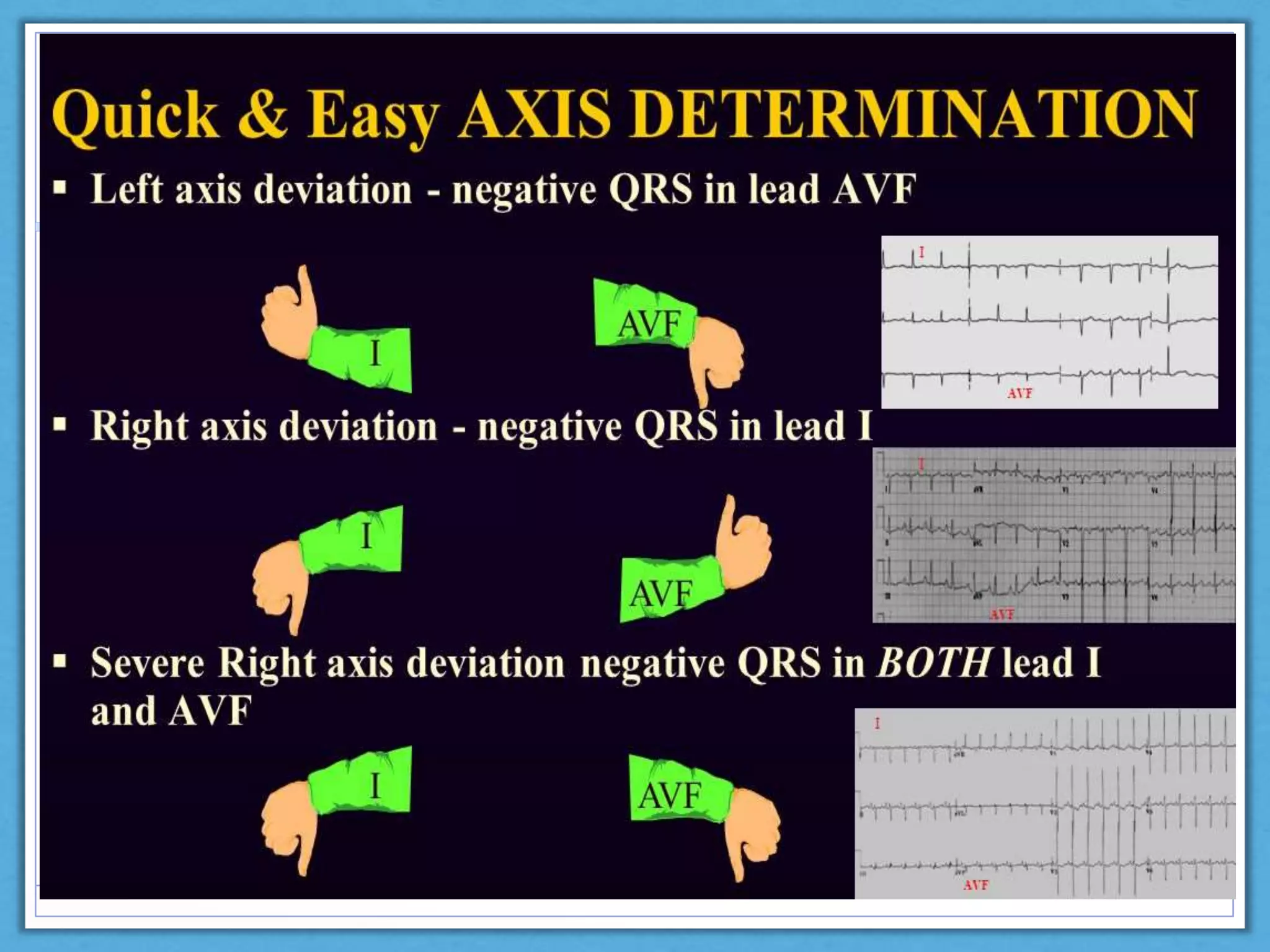 Normal ecg interpretation | PPTX