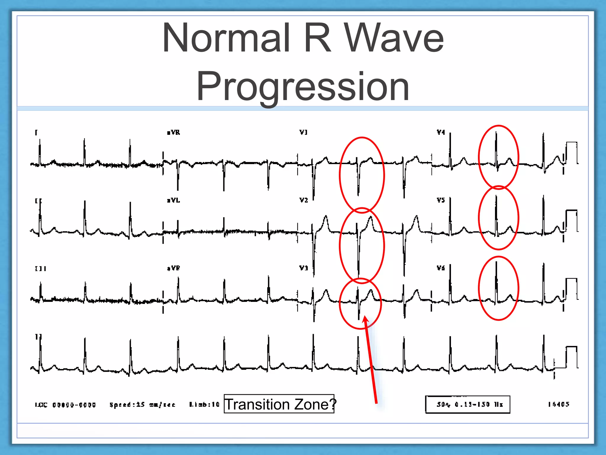 Normal ecg interpretation | PPTX | Heart and Cardiovascular Diseases ...