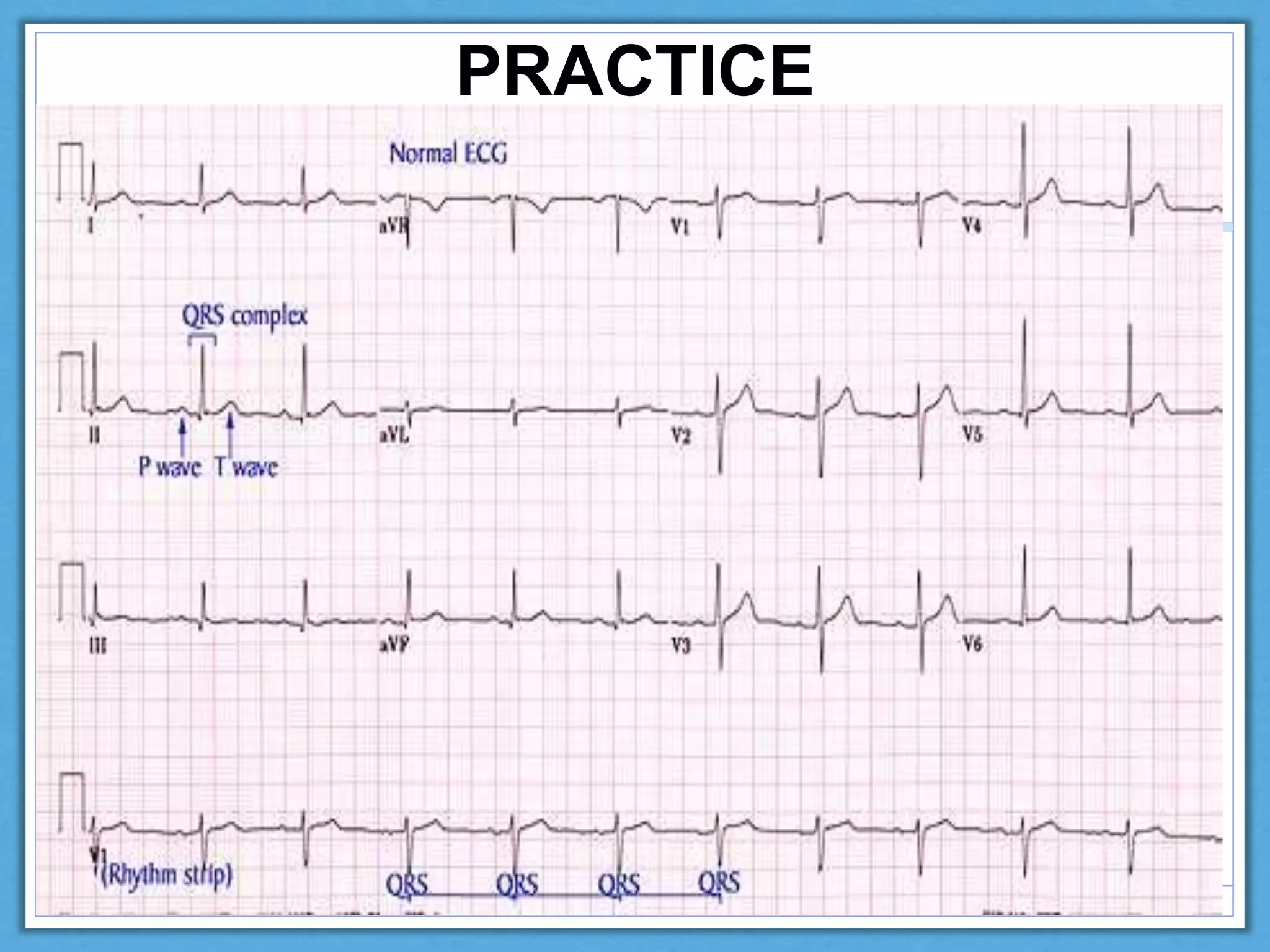 Normal ecg interpretation | PPTX