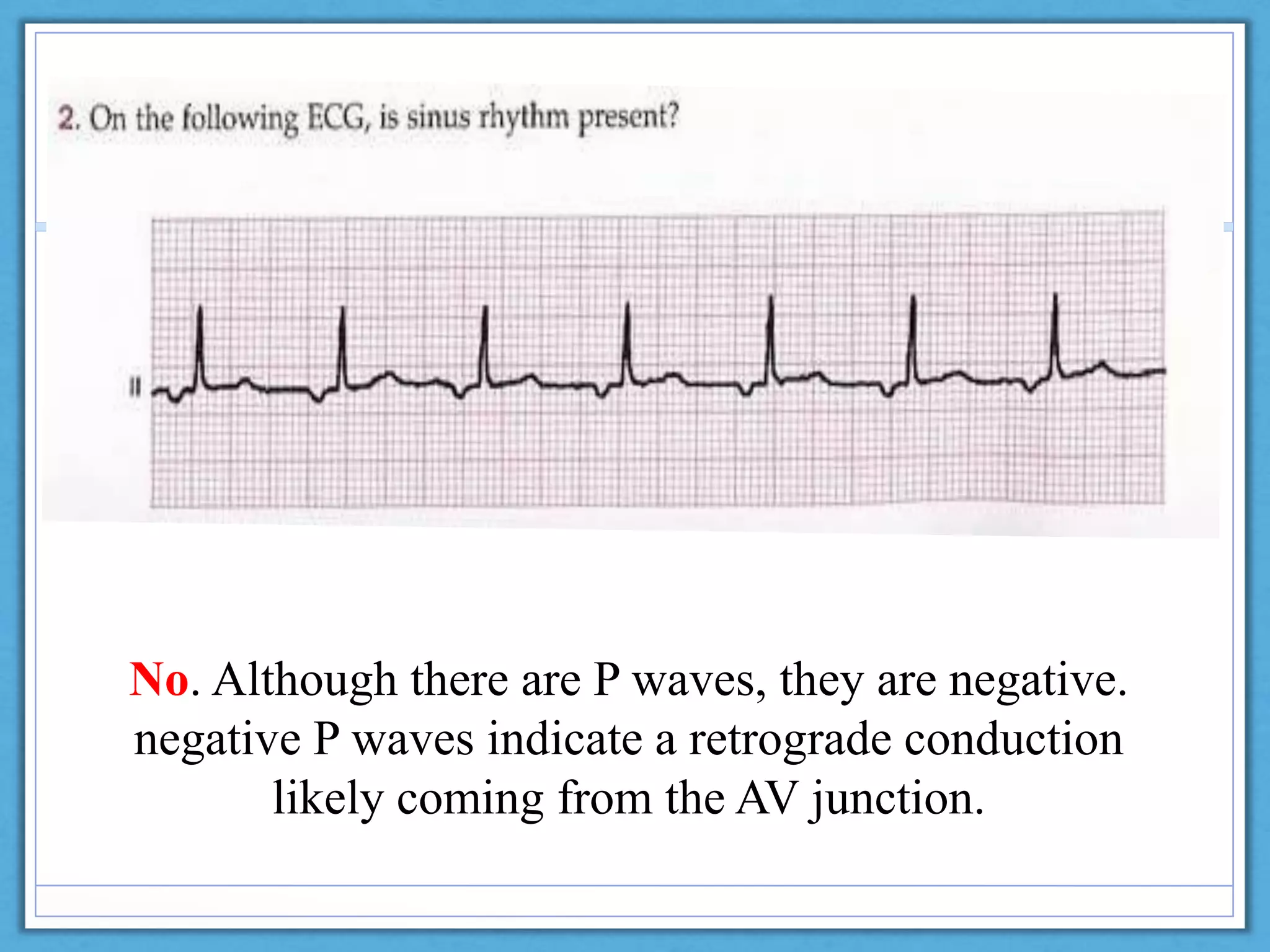 Normal ecg interpretation | PPTX