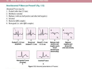 Normal ecg interpretation | PPTX