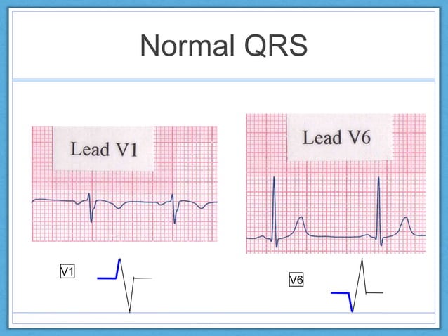 Normal ecg interpretation | PPTX | Heart and Cardiovascular Diseases ...