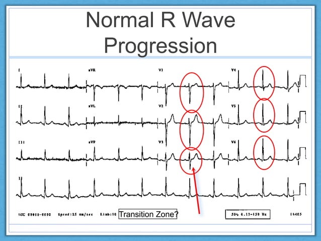 Normal ecg interpretation | PPTX | Heart and Cardiovascular Diseases ...